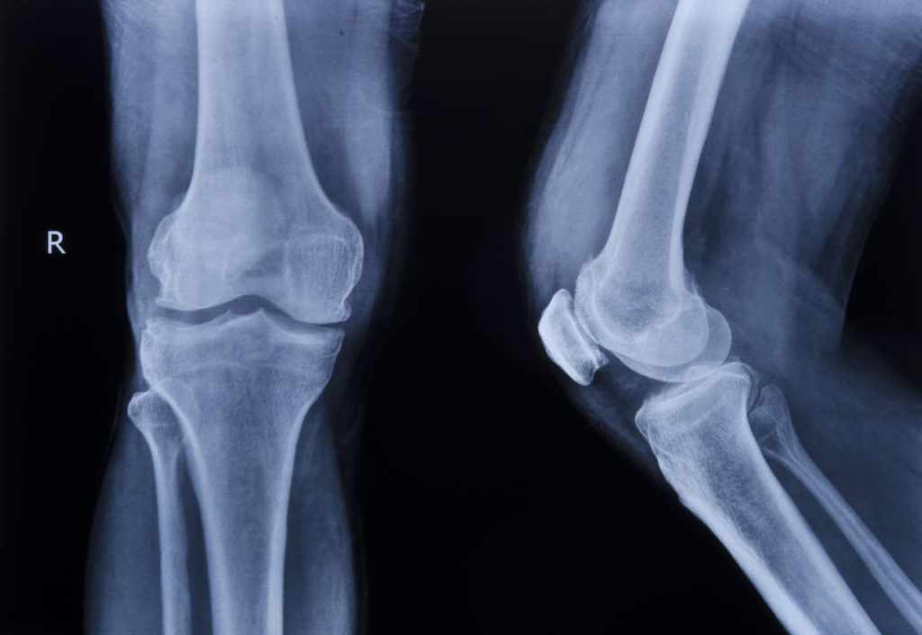 Atlanta Knee Injury Lawyer - Hasner Law, PC